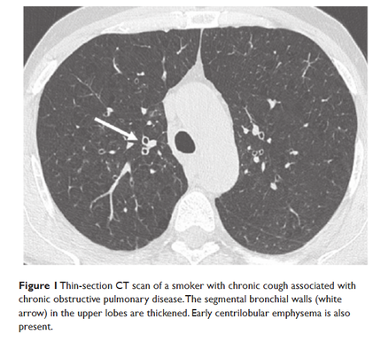 COPD患者のCT画像: JP-COPD